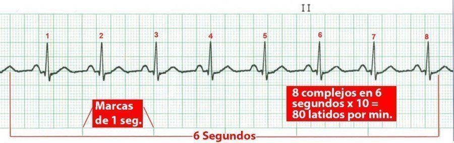 EMS Spain : Interpreta lo básico del ECG en 7 sencillos pasos,, Las 5 arritmias que debes saber ...