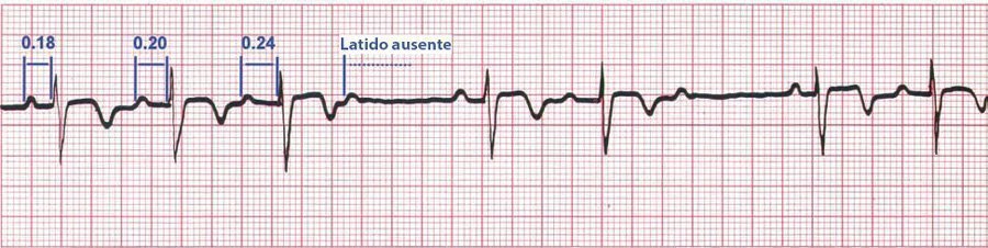 EMS Spain : Bloqueos cardiacos en el ECG